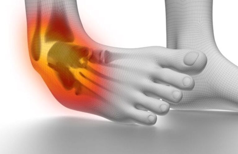What Does It Mean to Roll Your Ankle? - World Magazine 2024